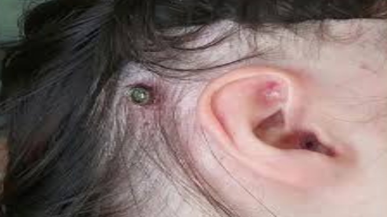 Baha Implant cures deafness, First operation in Northeast